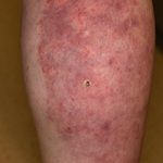 Tinea cruris - Altmeyers Encyclopedia - Department Dermatology