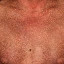 Baller-Gerold syndrome - Altmeyers Encyclopedia - Department Dermatology
