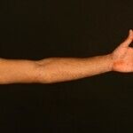 Nevus verrucosus - Altmeyers Encyclopedia - Department Dermatology