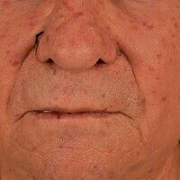 Scleroderma systemic Bilder - Altmeyers Enzyklopädie - Fachbereich ...