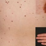 Familial atypical multiple birthmark and melanoma syndrome (FAMM ...