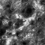 Actinic elastosis - Altmeyers Encyclopedia - Department Dermatology