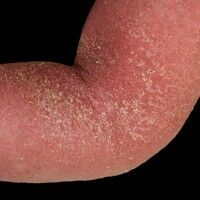 Bilder für Arm/Hand, Eiterbläschen/Eiterblase (Pustel), rot - Altmeyers ...