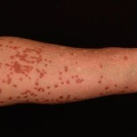 Koebner phenomenon Images - Altmeyers Encyclopedia - Department Dermatology