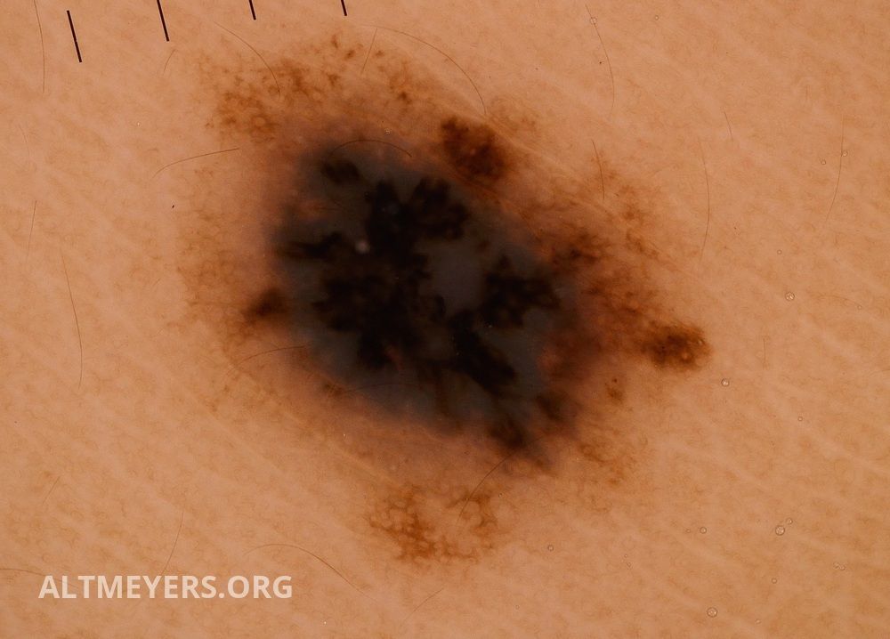 Benign Juvenile Melanoma