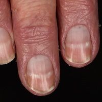 Leukonychia striata Bilder - Altmeyers Enzyklopädie - Fachbereich ...