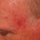 Blepharitis marginalis - Altmeyers Encyclopedia - Department Dermatology