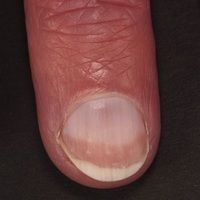 Leukonychie Images - Altmeyers Encyclopedia - Department Dermatology