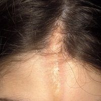 Scleroderma and coup de sabre Images - Altmeyers Encyclopedia ...