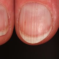 Nagelerkrankungen (Übersicht) Bilder - Altmeyers Enzyklopädie ...