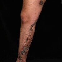 Angiokeratoma circumscriptum Images - Altmeyers Encyclopedia ...