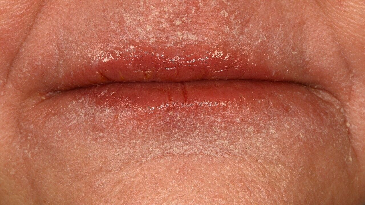 Ernstige Hoekige Cheilitis