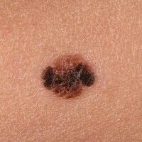 Naevus Spitz Bilder - Altmeyers Enzyklopädie - Fachbereich Dermatologie