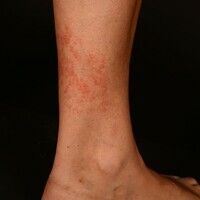 Purpura thrombocytopenic Images - Altmeyers Encyclopedia - Department ...