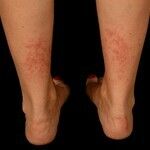 Purpura thrombocytopenic - Altmeyers Encyclopedia - Department Dermatology