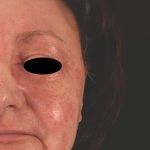 Airborne contact dermatitis - Altmeyers Encyclopedia - Department ...