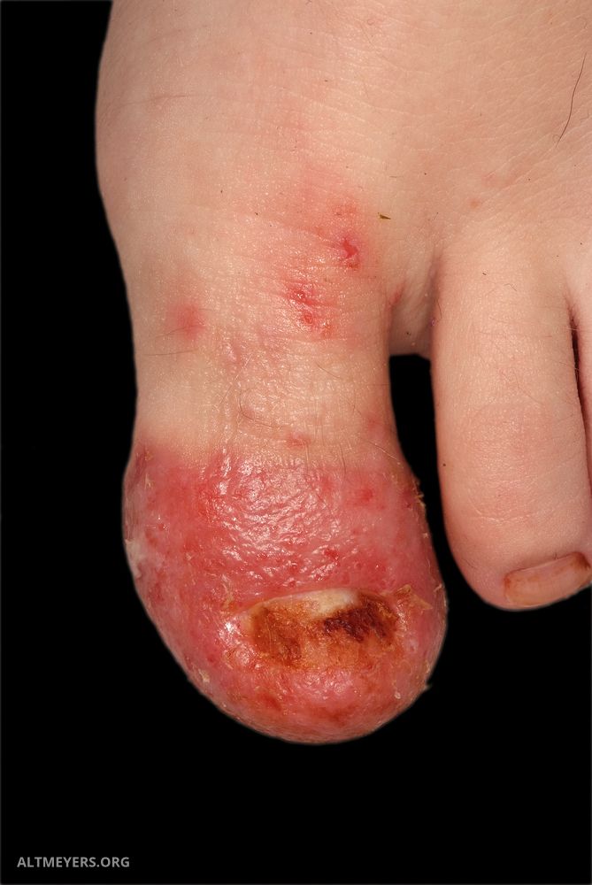 Acrodermatitis Continua Of Hallopeau