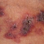 Angiokeratoma circumscriptum - Altmeyers Encyclopedia - Department ...