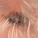 Angiosarcoma of the head and face skin - Altmeyers Encyclopedia ...