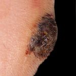 Angiosarkom der Kopf- und Gesichtshaut - Altmeyers Enzyklopädie ...