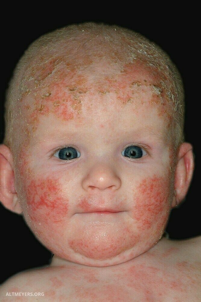 Impetigo In Children Face