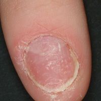 Eczema nail Images - Altmeyers Encyclopedia - Department Dermatology