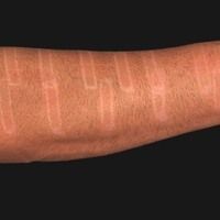 Scar atrophic Images - Altmeyers Encyclopedia - Department Dermatology