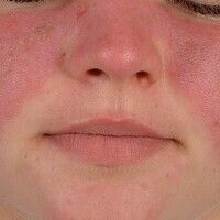 Lupus erythematosus systemic Images - Altmeyers Encyclopedia ...