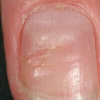 Nail diseases (overview) Images - Altmeyers Encyclopedia - Department ...