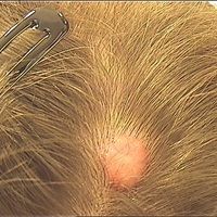 Cylindrome Images - Altmeyers Encyclopedia - Department Dermatology