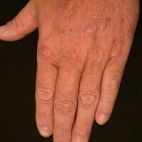 Lichen ruber verrucosus Images - Altmeyers Encyclopedia - Department ...