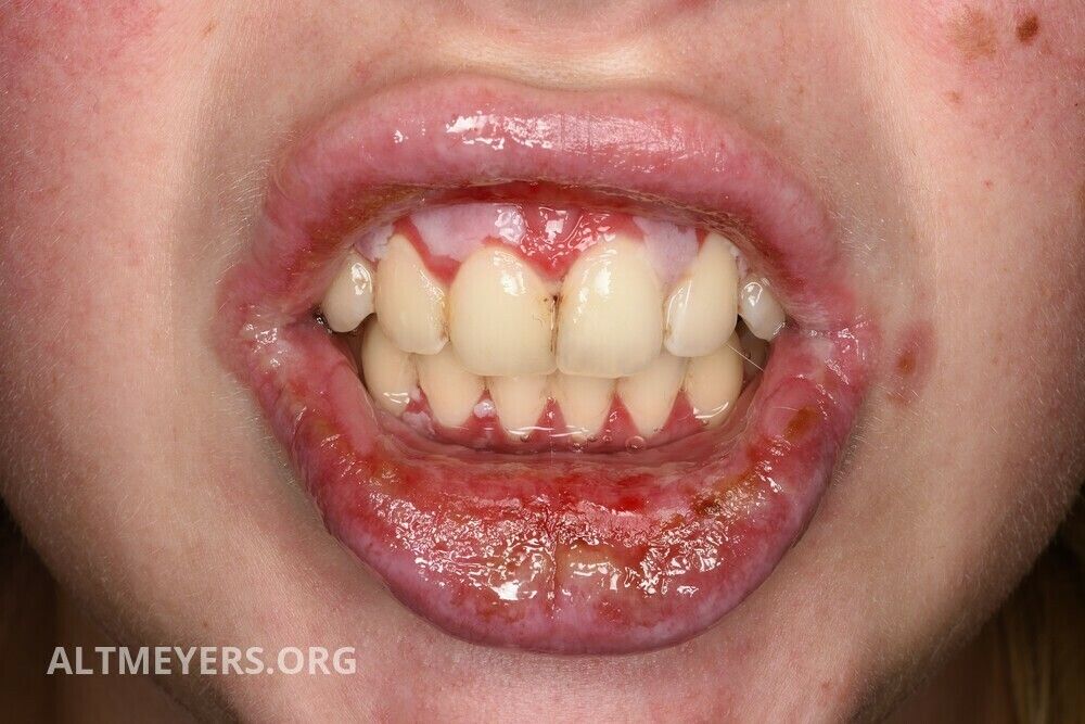 Steven Johnson Syndrome Oral Lesions