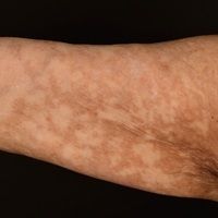 Poikiloderma (overview) Images - Altmeyers Encyclopedia - Department Dermatology