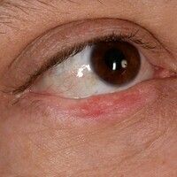 Lupus erythematodes chronicus discoides Images - Altmeyers Encyclopedia ...