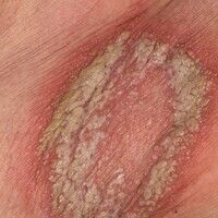 Candidosis intertriginous Images - Altmeyers Encyclopedia - Department ...