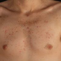 Akne (Übersicht) Bilder - Altmeyers Enzyklopädie - Fachbereich Dermatologie