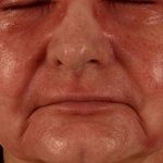 Airborne contact dermatitis - Altmeyers Encyclopedia - Department ...