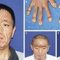 Pachydermoperiosteosis, primary Images - Altmeyers Encyclopedia ...