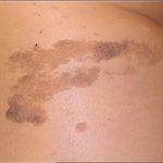 Nevus verrucosus - Altmeyers Encyclopedia - Department Dermatology