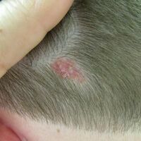 Naevus sebaceus Bilder - Altmeyers Enzyklopädie - Fachbereich Dermatologie
