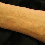 Syringome disseminated - Altmeyers Encyclopedia - Department Dermatology