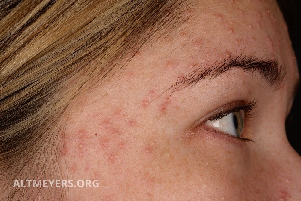 Polymorphic Light Eruption Face