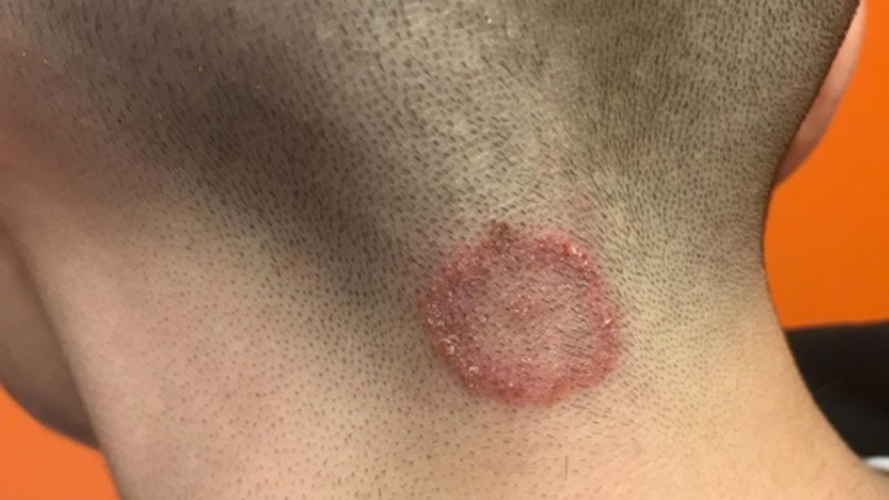 Tinea Capitis Ponto Preto Tinea Capitis (schimmelinfectie Van Het