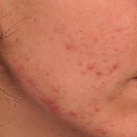 Pustel Bilder - Altmeyers Enzyklopädie - Fachbereich Dermatologie