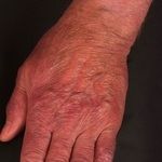 Acrodermatitis chronica atrophicans - Altmeyers Encyclopedia ...