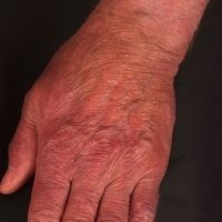 Acrodermatitis chronica atrophicans Images - Altmeyers Encyclopedia ...