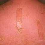 Dermatitis solaris - Altmeyers Enzyklopädie - Fachbereich Dermatologie