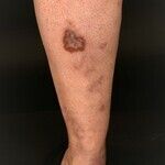 Livedo racemosa (Übersicht) - Altmeyers Enzyklopädie - Fachbereich ...