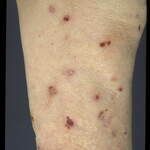 Prurigo simplex subacuta - Altmeyers Enzyklopädie - Fachbereich ...