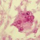 Bridge scars - Altmeyers Encyclopedia - Department Dermatology